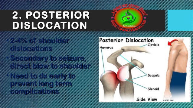 Shoulder Dislocation; Causes, Symptom, Diagnosis, Treatment ...