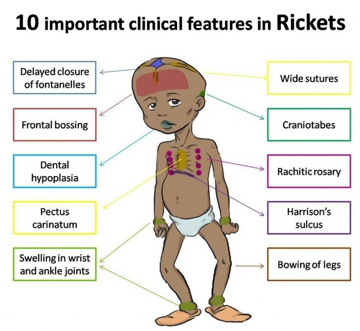Rickets Treatment, Causes, Symptoms – illnesshacker