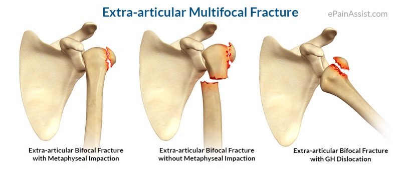 Proximal Humeral Fractures; Causes, Diagnosis, Treatment – illnesshacker