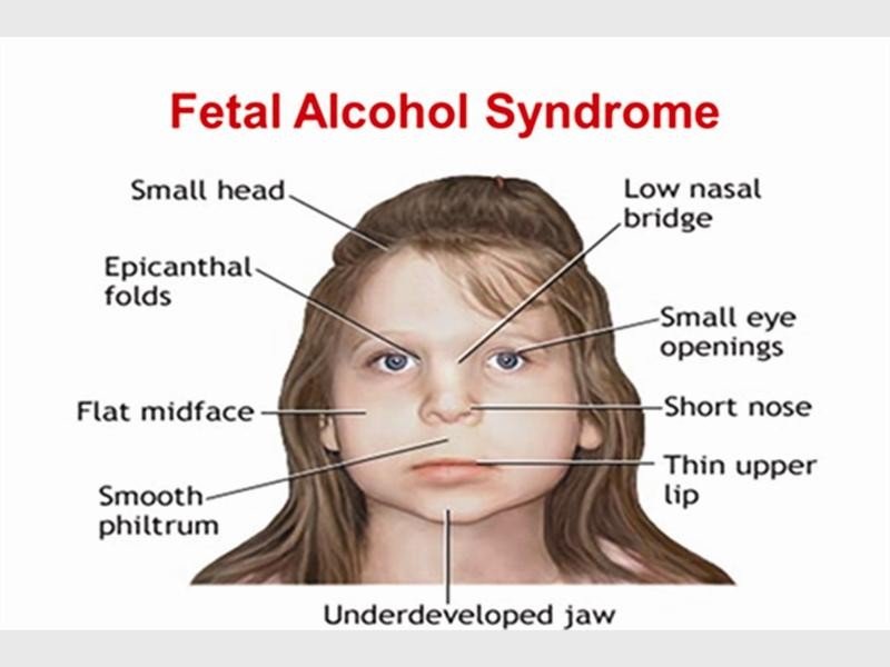 What Is Fetal Alcohol Syndrome? Symptoms, Treatment – illnesshacker