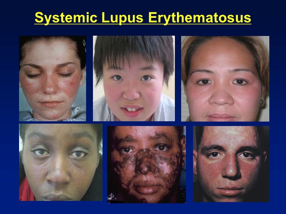 Types of Systemic Lupus Erythematosus – illnesshacker