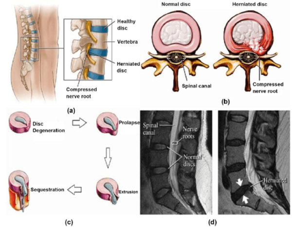 L5 Lumbar Radiculopathy – Causes, Symptoms, Treatment – illnesshacker