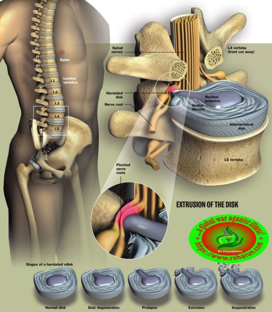 Posterior Disc Bulge Between L1 – L2 – Symptoms, Treatment – illnesshacker